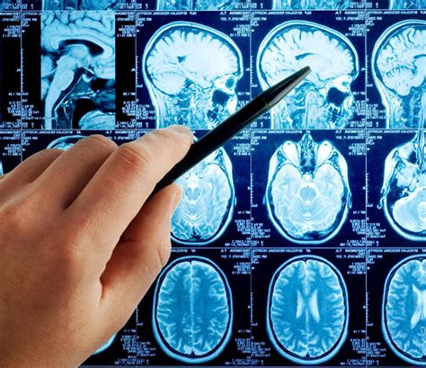 What Is A Brain Stem Tumor With Pictures