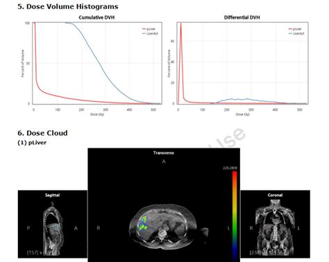 Torch Dosimetry Software Platform As A Complete Y90 Transarterial