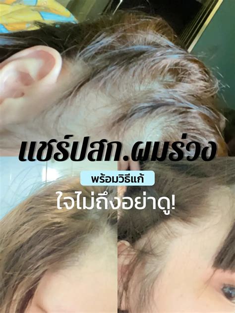 แชร์ประสบการณ์ผมร่วง สุดสยอง แกลเลอรีที่โพสต์โดย Shersher Lemon8