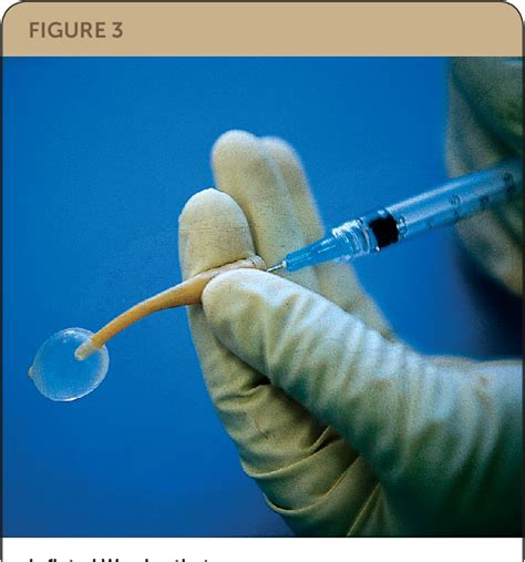 Figure 1 From Bartholin Duct Cyst And Gland Abscess Office Management Semantic Scholar