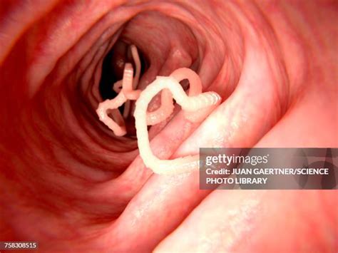 Tapeworm Photos And Premium High Res Pictures Getty Images
