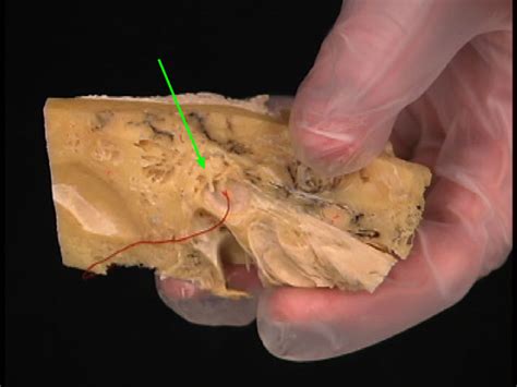 Tympanic Canaliculus