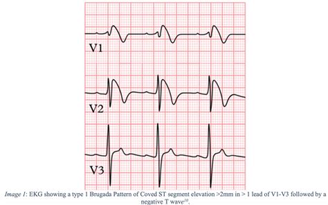 Brugada Syndrome Heart Condition