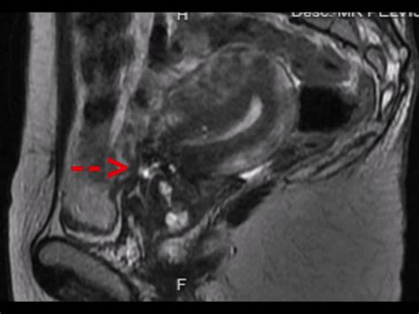 Isthmocele Endometriosis The Relationship Between Cesarean Section And
