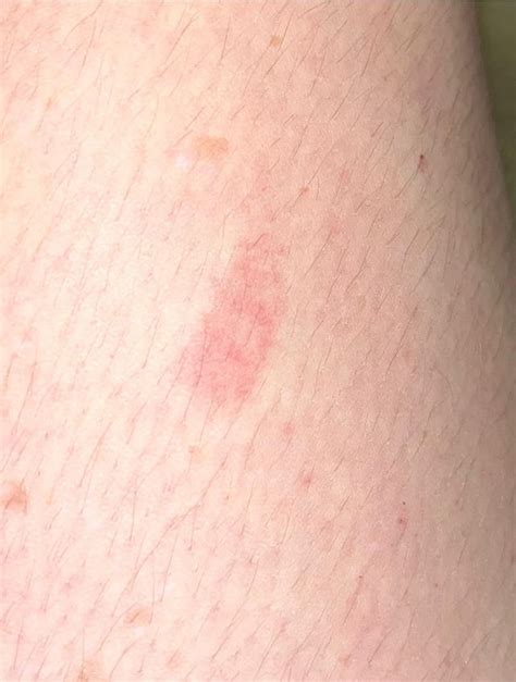 Is This Ringworm Rdermatology