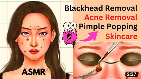 Asmr Blackhead Removal Acne Removal Skin Care At Home Pimple