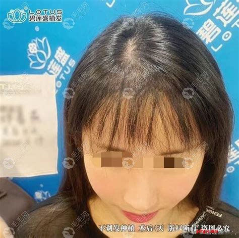 碧莲盛植发多少钱现使用bht或sht技术花5000块就可以植发了 热点资讯 毛毛网
