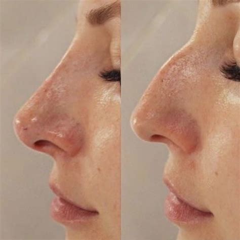 Pin Av Capture På Rhinoplasty Nose Jobs I 2024