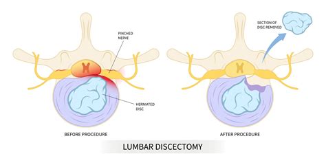 What Is The Difference Between Forminotomy Discectomy And Laminectomy New Jersey