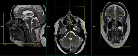 10th Cranial Nerve Mri