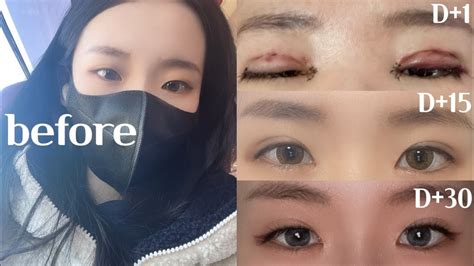 드디어 쌍수함 매몰쌍수 앞뒷트임 브이로그 한 달 붓기 가라앉는 과정 Youtube