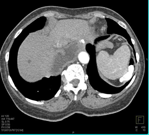 Dilated Esophagus With Retained Food And Contrast Esophagus Radiology