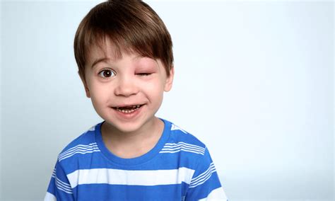 Angioedema Dr Shareefa Chause