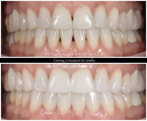 New Treatment For Black Triangles Between Teeth Saylor Dentistry