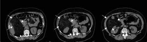 Retrorectal Hibernoma A Rare Tumor With Unusual Presentation