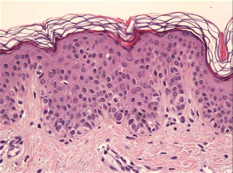 Clear Cell Papulosis A Case Report And Its Possible Association With