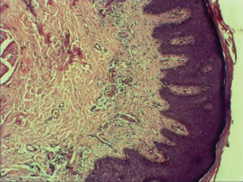 Acute Methotrexate Toxicity Presenting As Ulcers In Plaques Of