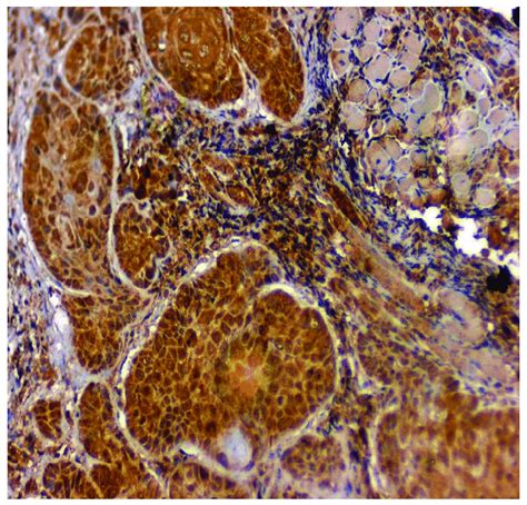 Ihc For Ca1 In Oscc Samples Under 20× Magnification Download