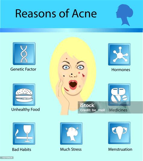 여드름 이유입니다 피부 문제와 질병 아름다움 인포 그래픽 벡터 일러스트입니다 건강관리와 의술에 대한 스톡 벡터 아트 및 기타 이미지 건강관리와 의술 건조한 깨끗한