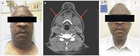 Iodide Associated Sialadenitis NEJM