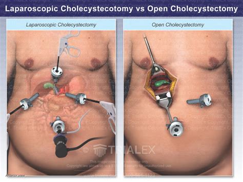 Laparoscopic Cholecystectomy Vs Open Cholecystectomy Trialquest