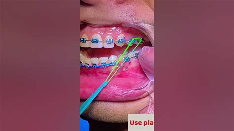 Rubber Bands Class 3 Elastics Orthodontics Youtube