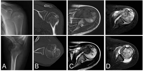Chondroblastoma In Left Humerus Of A 13 Year Old Female Plain Download Scientific Diagram