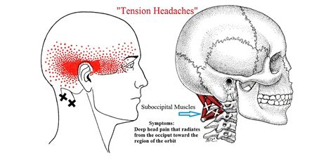 Trigger Point Massage Oc