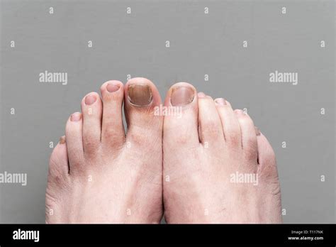 Pies masculinos onicomicosis con infección micótica de las uñas