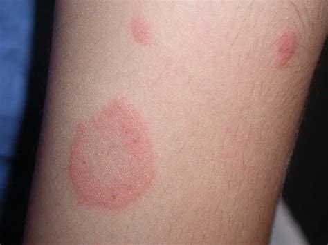 Folk Treatment For Pityriasis Versicolor Diseases And Conditions