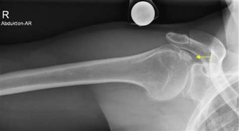The Same 45 Year Old Man From Figure 3 With Calcific Tendinitis Yellow