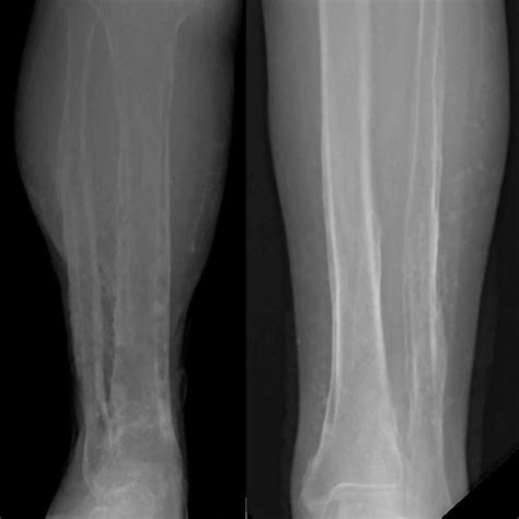 Periosteal Reaction And Types Of Periosteal Reaction