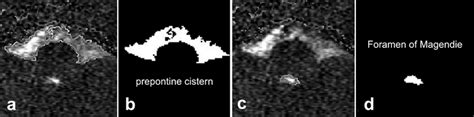 The Result Of The Semi Automatic Segmentation A Prepontine Cistern