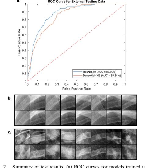 Lung Nodule Detection Models Code And Papers Catalyzex