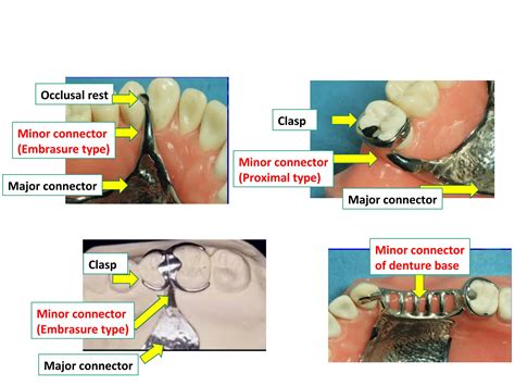 5 Minor Connectors Removable Partial Denture Ppt