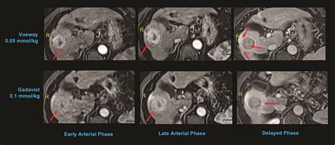 Vueway™ Gadopiclenol Practical Considerations For Use Applied