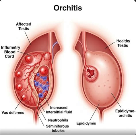 Orchitis In Korea Koreahealth Global
