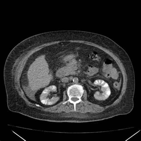Atn Imaging With Iodinated Contrast Typically Demonstrates An