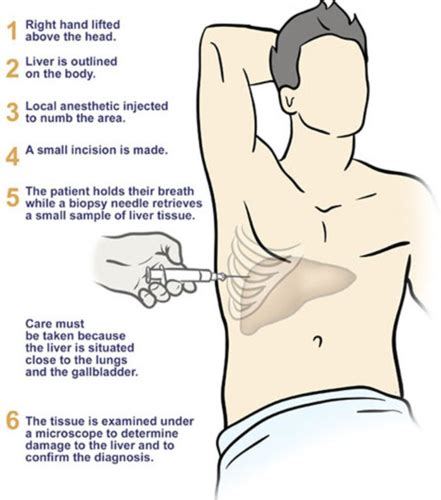 Liver Dysfunction Flashcards Quizlet