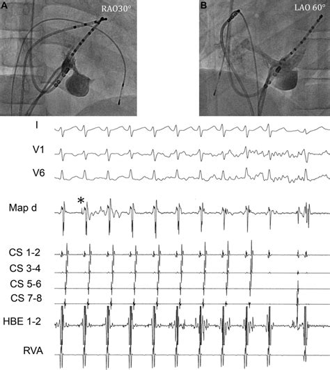 Cs Diverticulum In A 9year Old Female Patient 2 With Recurrent Svt
