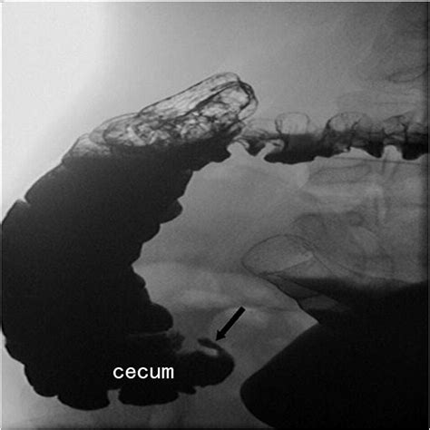 What Is An Inverted Appendiceal Stump At Liza Tubbs Blog