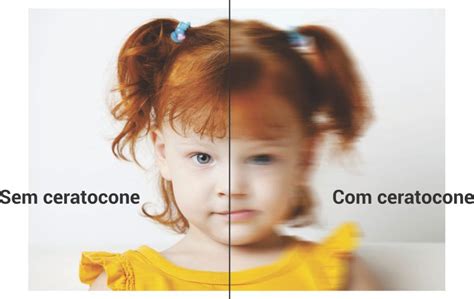 Os Sintomas Do Ceratocone Tem Cura Qual Tratamento