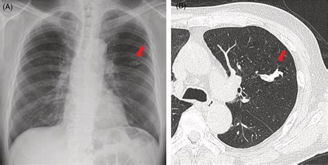 A Chest X‐ray Showing A Spindle‐shaped Calcification In The Left