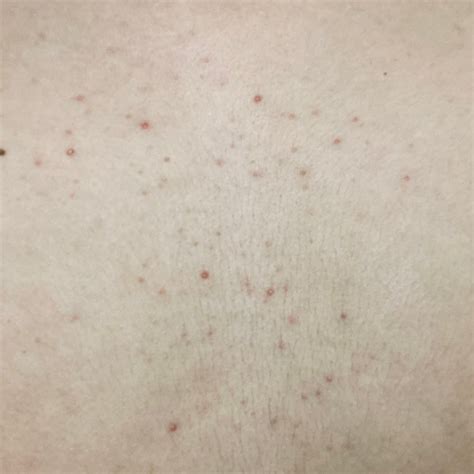 피부에 두드러기 여드름 같은게 올라옵니다 가슴부위쪽에서 시작해서 어깨쪽으로 올라와여 전담핀 후로 이렇게 됐는데 전담