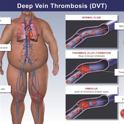 Bowel Obstruction From Ivc Filter Trial Exhibits Inc