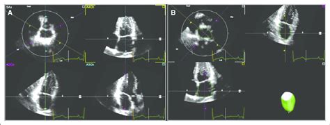 Three Dimensional Echocardiography 3de Quantification Of Left Atrial