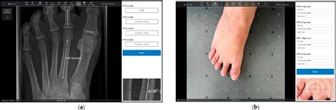 Figure 1 From The Controversial Definition Of Normal Toe Alignment Semantic Scholar