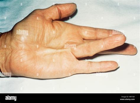La Maladie De Dupuytren Photo Stock Alamy