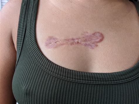 Keloid