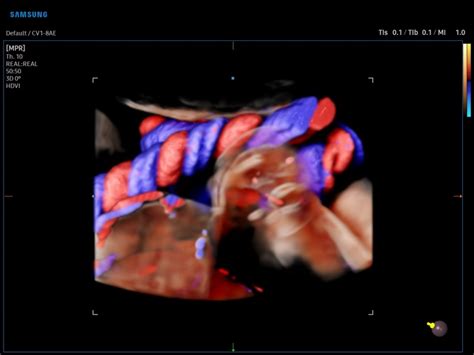 Ultrasound Images Umbilical Cord Crystalvue Flow Echogramm